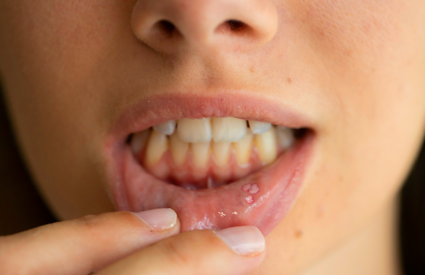 Aphthen | Mundhygiene | Gesundheitsratgeber | MEIN TAG